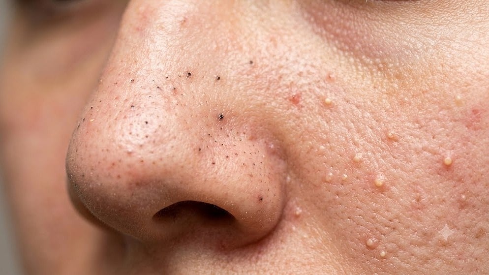 Blackheads/whiteheads ಸಮಸ್ಯೆ ಶಾಶ್ವತವಾಗಿ ದೂರಾಗಿಸುವುದು ಹೇಗೆ..? ಇಲ್ಲಿದೆ ...