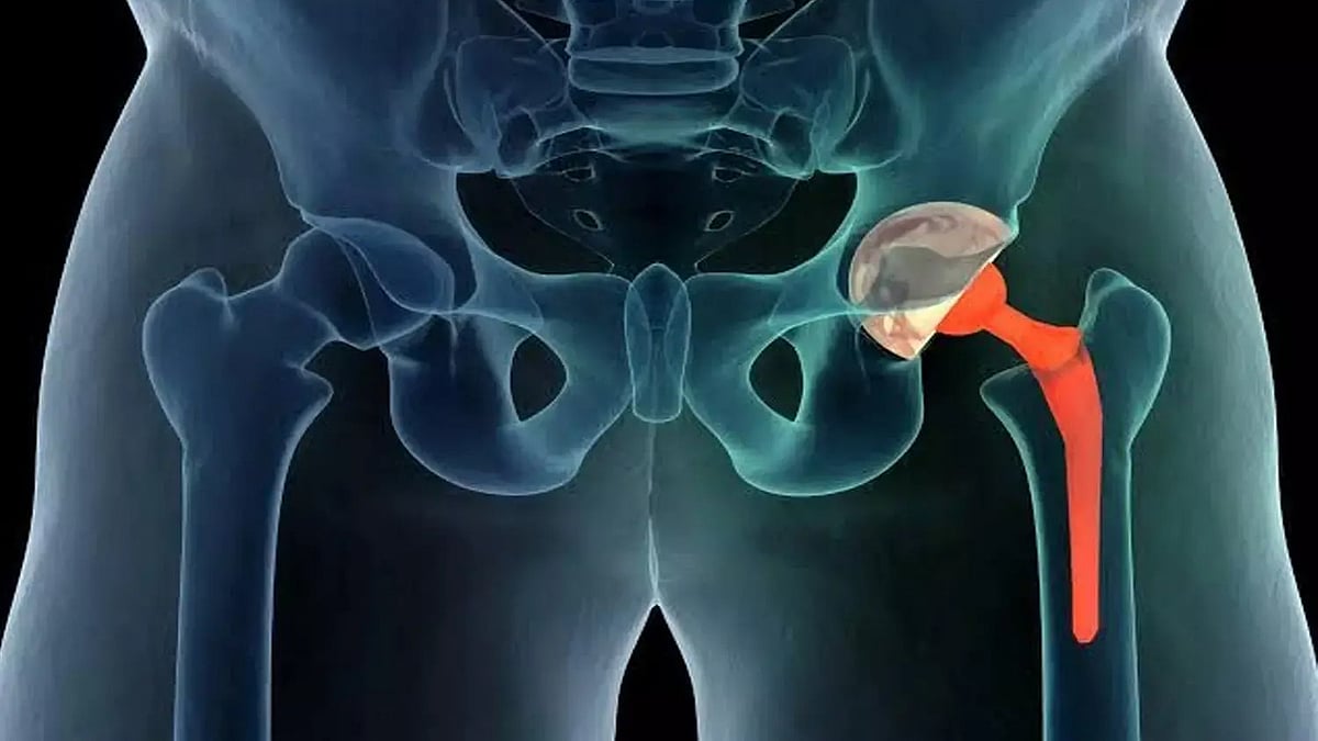 Complex hip reconstruction using patient-specific 3D-printed implant