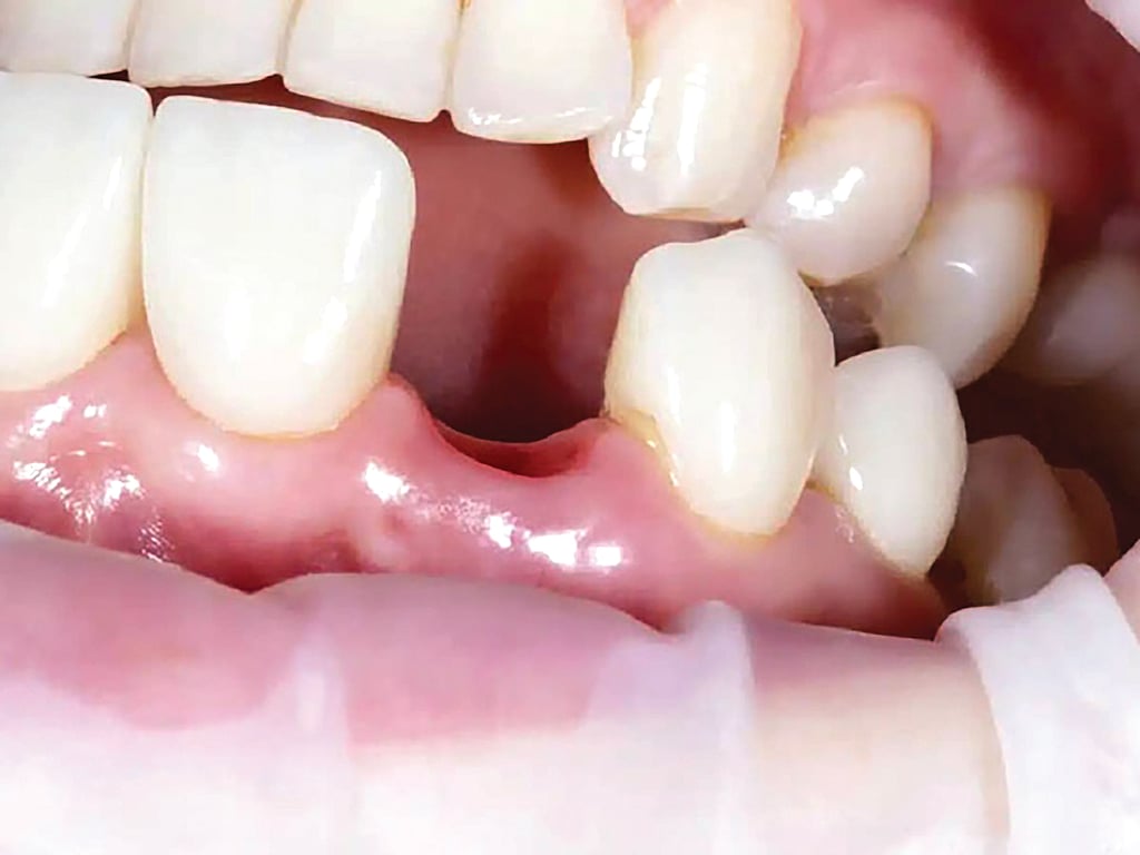 New Teeth Growth Research | दात पडल्यास आता टेन्शन नाही... पुन्हा ...