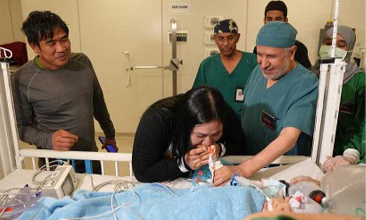 Saudi surgeons separate 4th Filipino conjoined twins